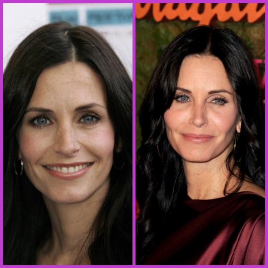 Botox, il prima e il dopo delle star | Donna Fanpage