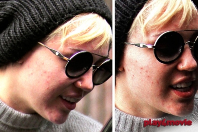 Miley Cyrus: L'acne mi rende di pessimo umore, tutti mi fissano!