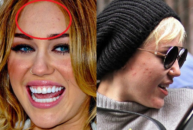 Miley Cyrus confessa: Ero depressa a causa dell'acne
