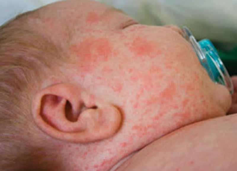 Morbillo, 385 i casi ad aprile: quintuplicati rispetto allo stesso ...