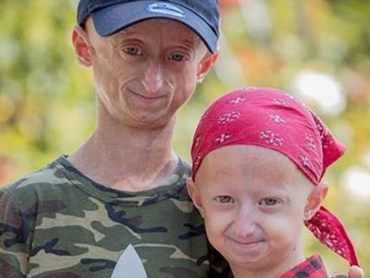 Fratelli affetti da progeria, la malattia che fa sembrare più vecchi ...